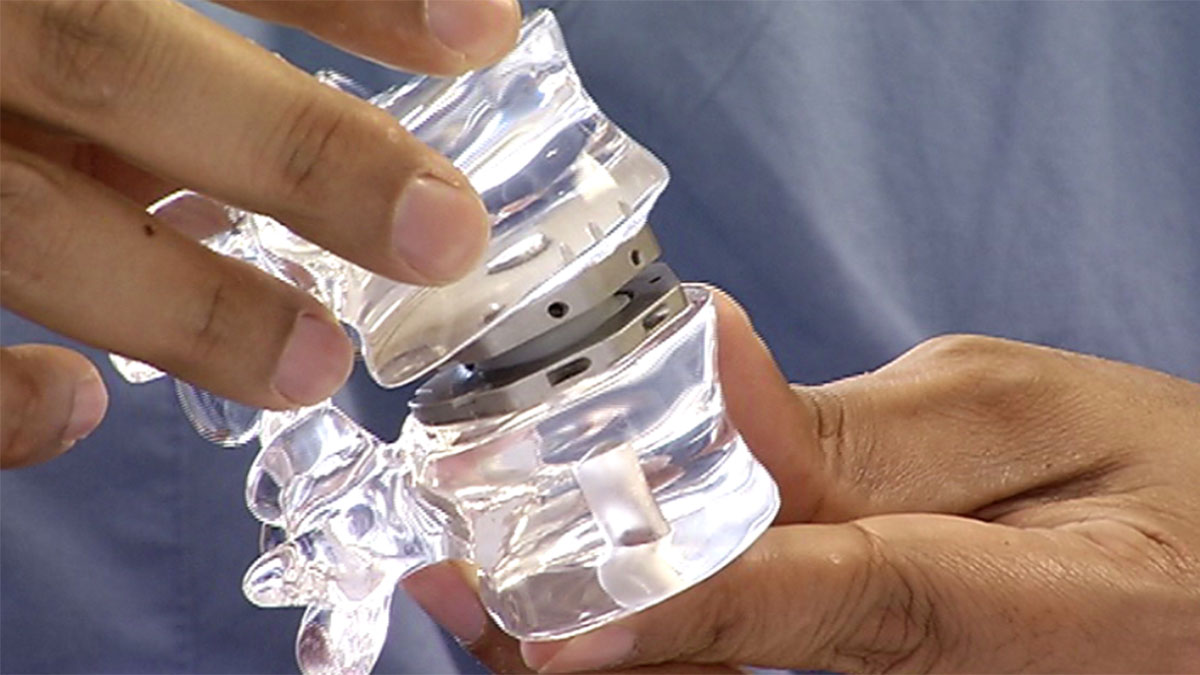 Artificial Discs Offer Long-Term Results for Degenerative Disc Disease ...