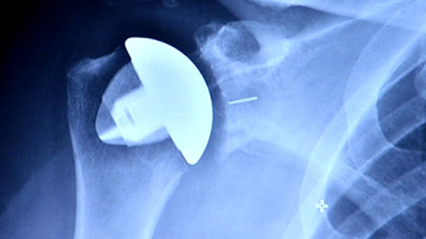 New Device Improves Shoulder Replacement Procedure – NBC4 Washington
