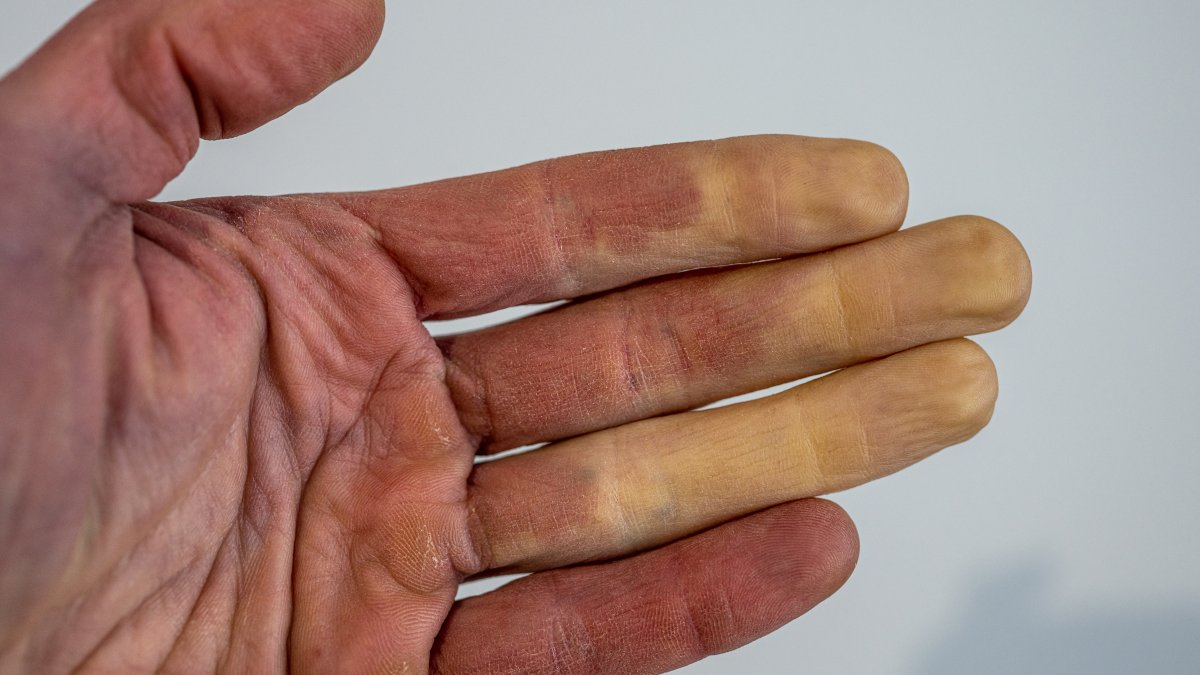 What Is Raynauds Disease Nbc4 Washington