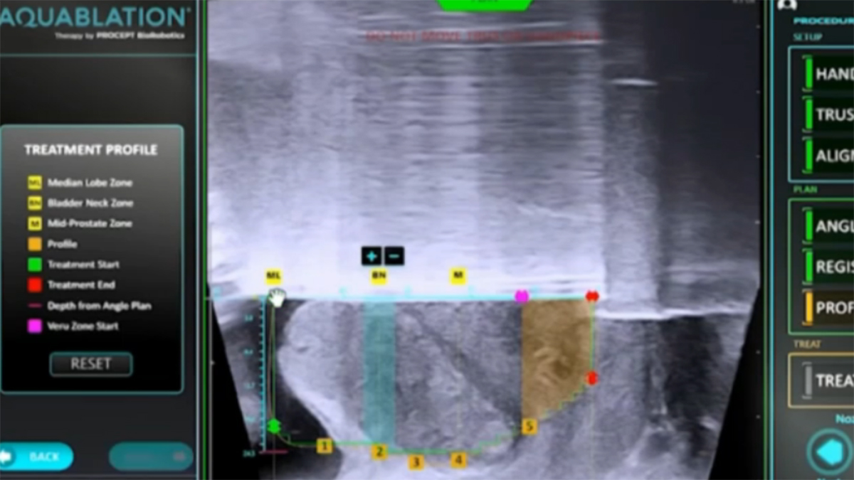 ‘Almost an immediate change’: Robotic surgery prostate relief – NBC4 ...