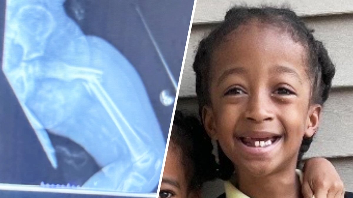 Family wants answers on how 7-year-old fractured his femur in ...